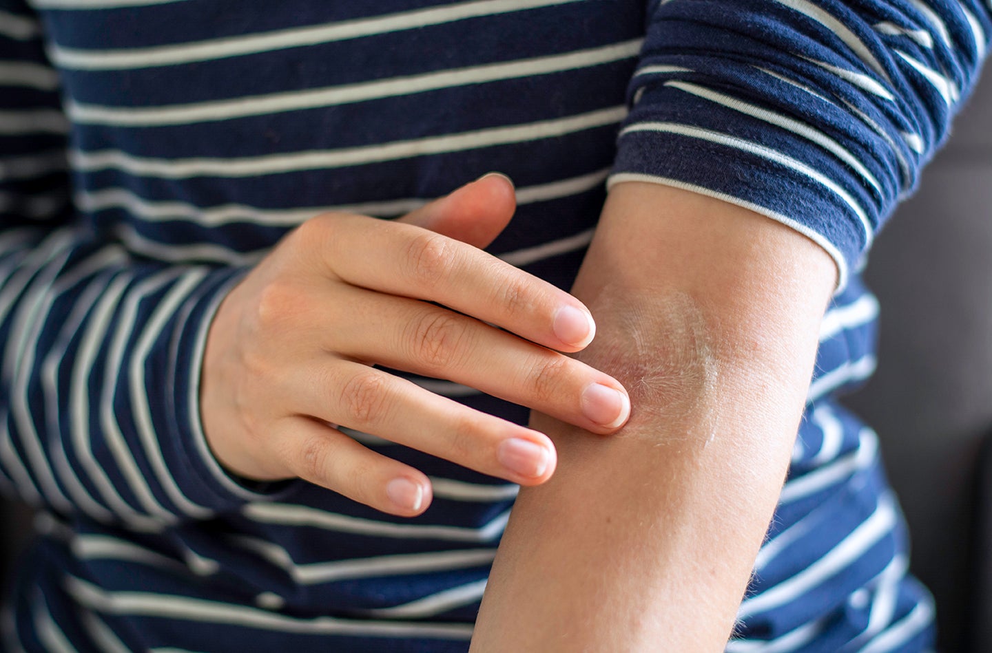 What does steroid cream do? | Optum Perks