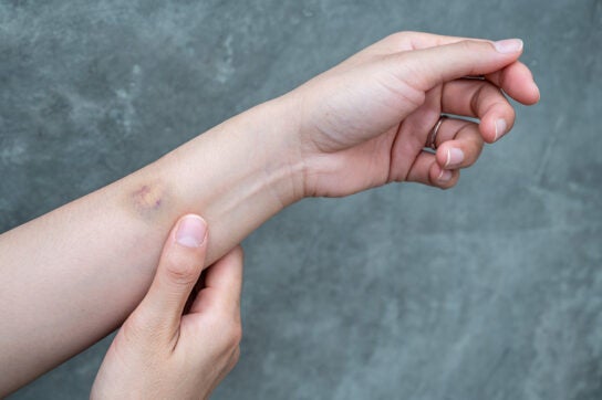 Causes and types of leukemia bruises | Optum Perks