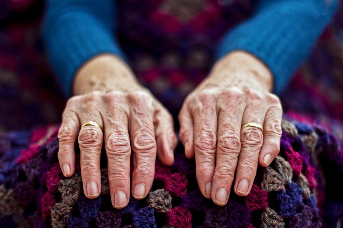 Psoriatic arthritis and your nails: Symptoms, causes, and treatments ...