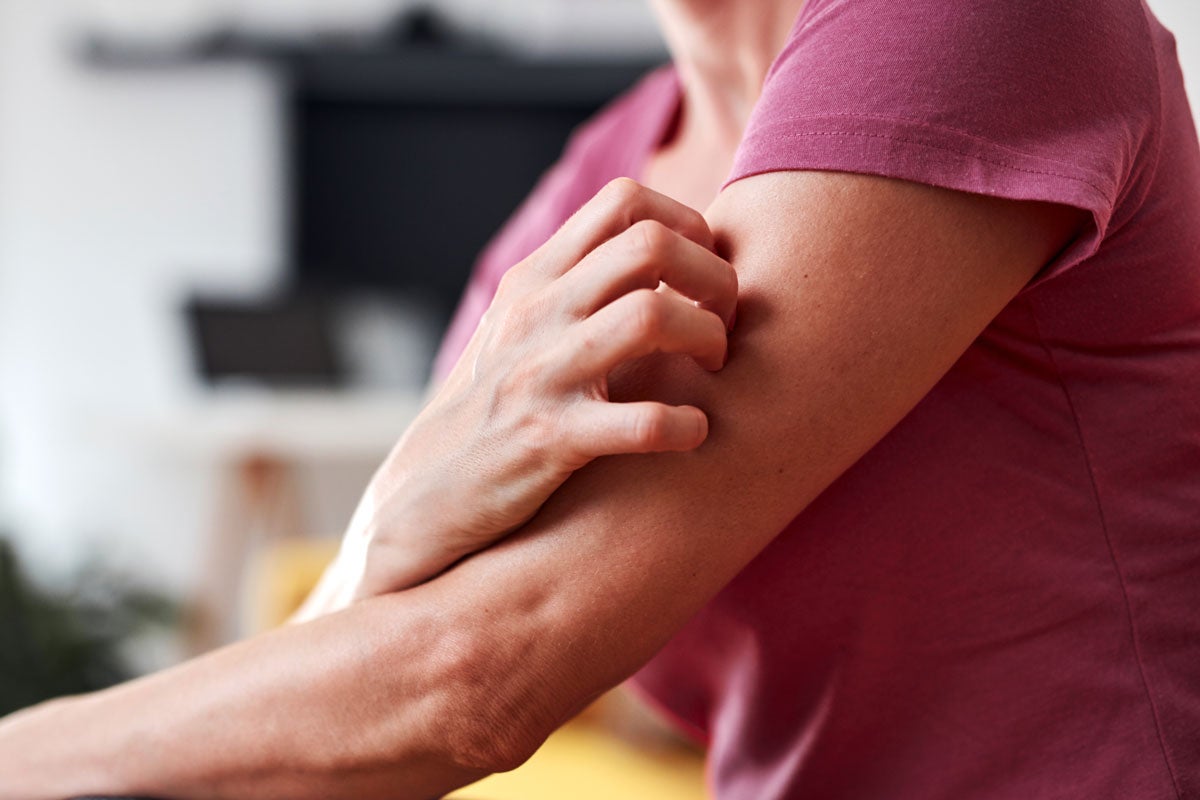 Hives from stress: Causes, treatment, and prevention | Optum Perks