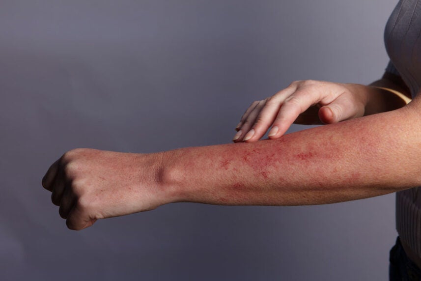 How long do HIV rashes last? Symptoms, causes, and treatment | Optum Perks