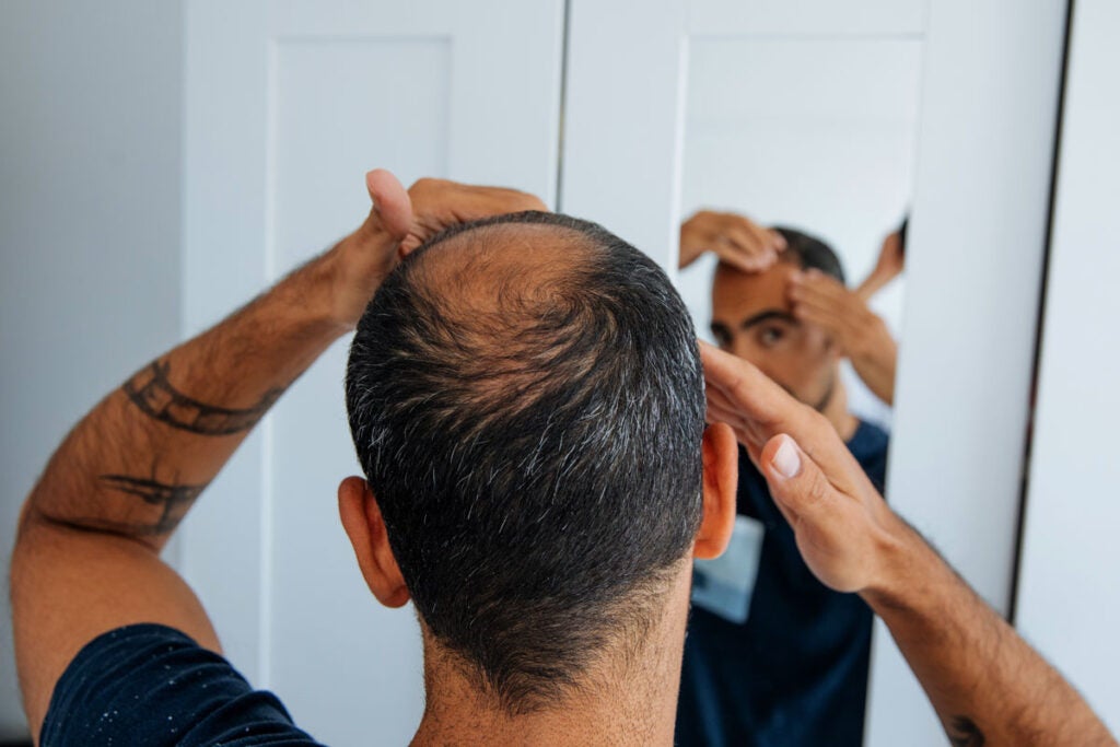 Finasteride for hair loss or prostate — Where and how to get | Optum Perks