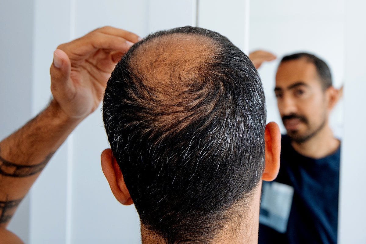 Health insurance coverage and hair loss treatments — What to know ...