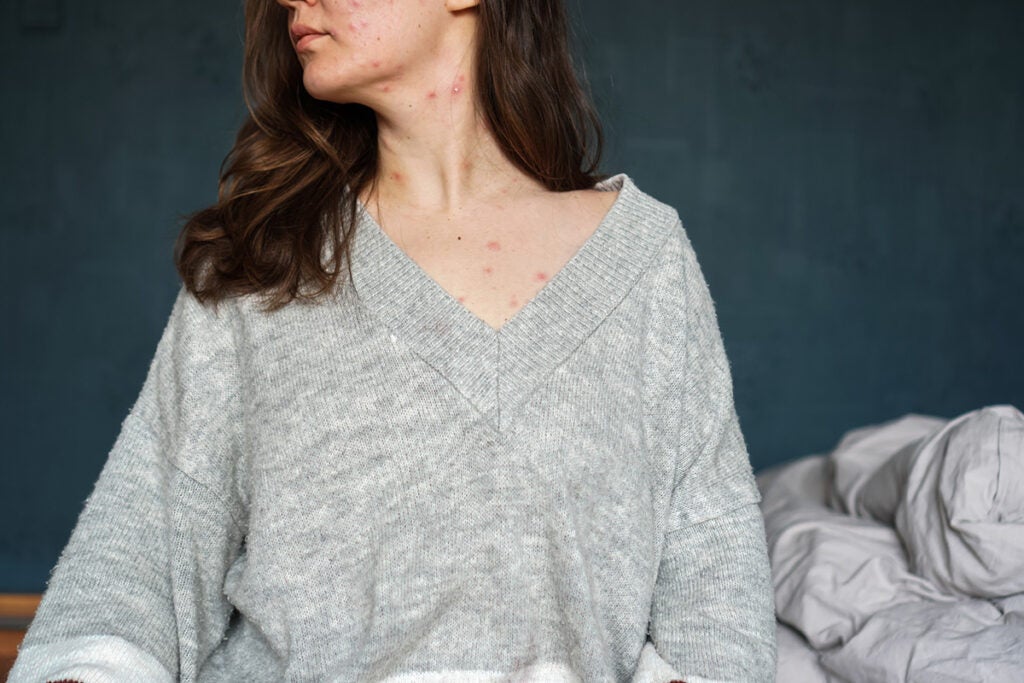 Chickenpox in adults — What you should know | Optum Perks